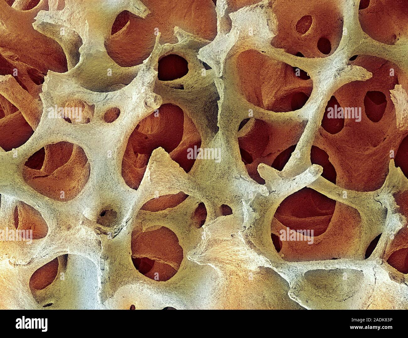 Bone tissue. Coloured scanning electron micrograph (SEM) of cancellous ...