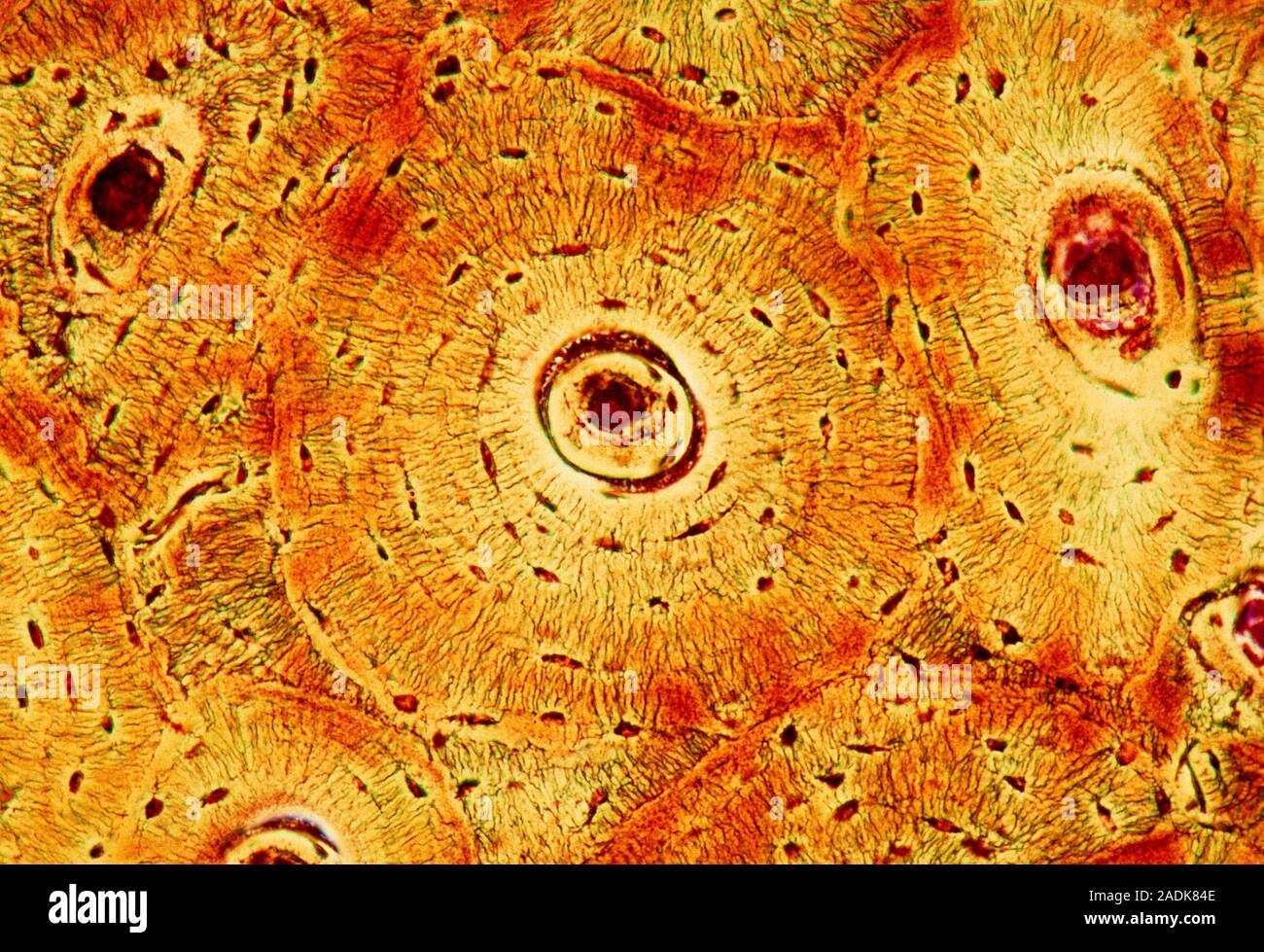 Bone canals. Coloured light micrograph of a section through human ...