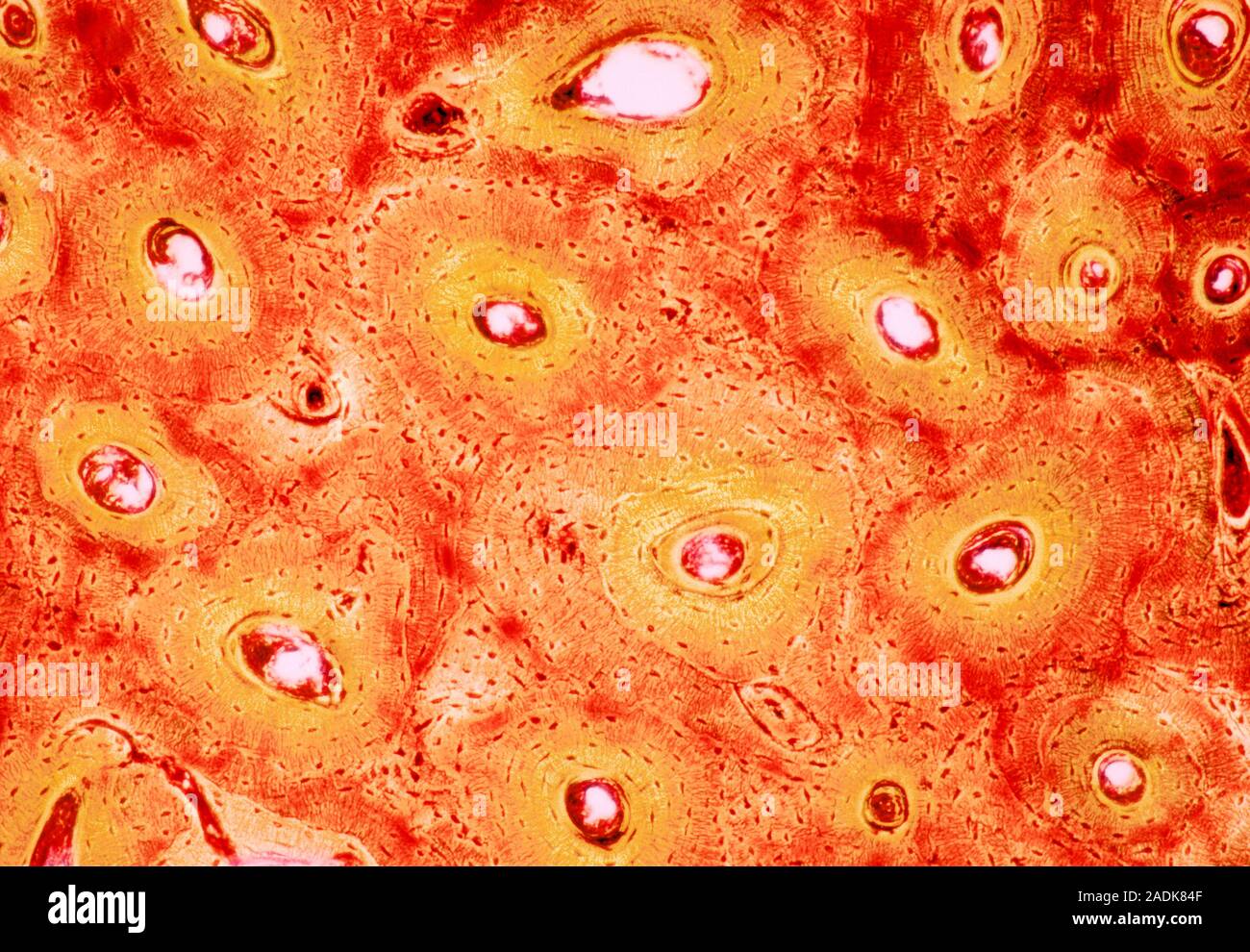 Bone canals. Coloured light micrograph of a section through human ...
