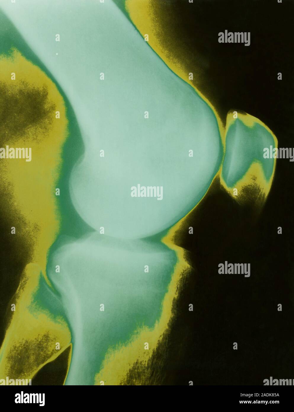 Colorvir X-ray photo of a normal knee joint showing tibia, femur and ...