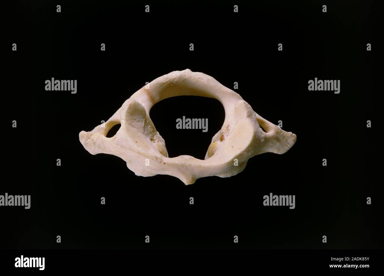 Photograph of the human atlas bone, the first cervical vertebra, and ...