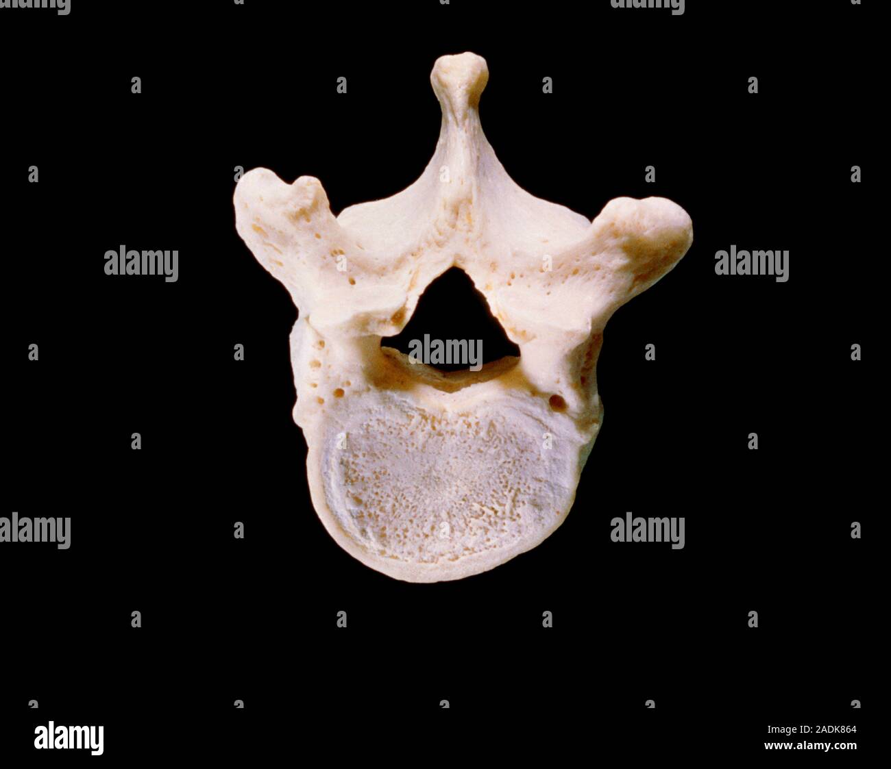 Photograph of the human first lumbar vertebra (L1), one of five bones ...