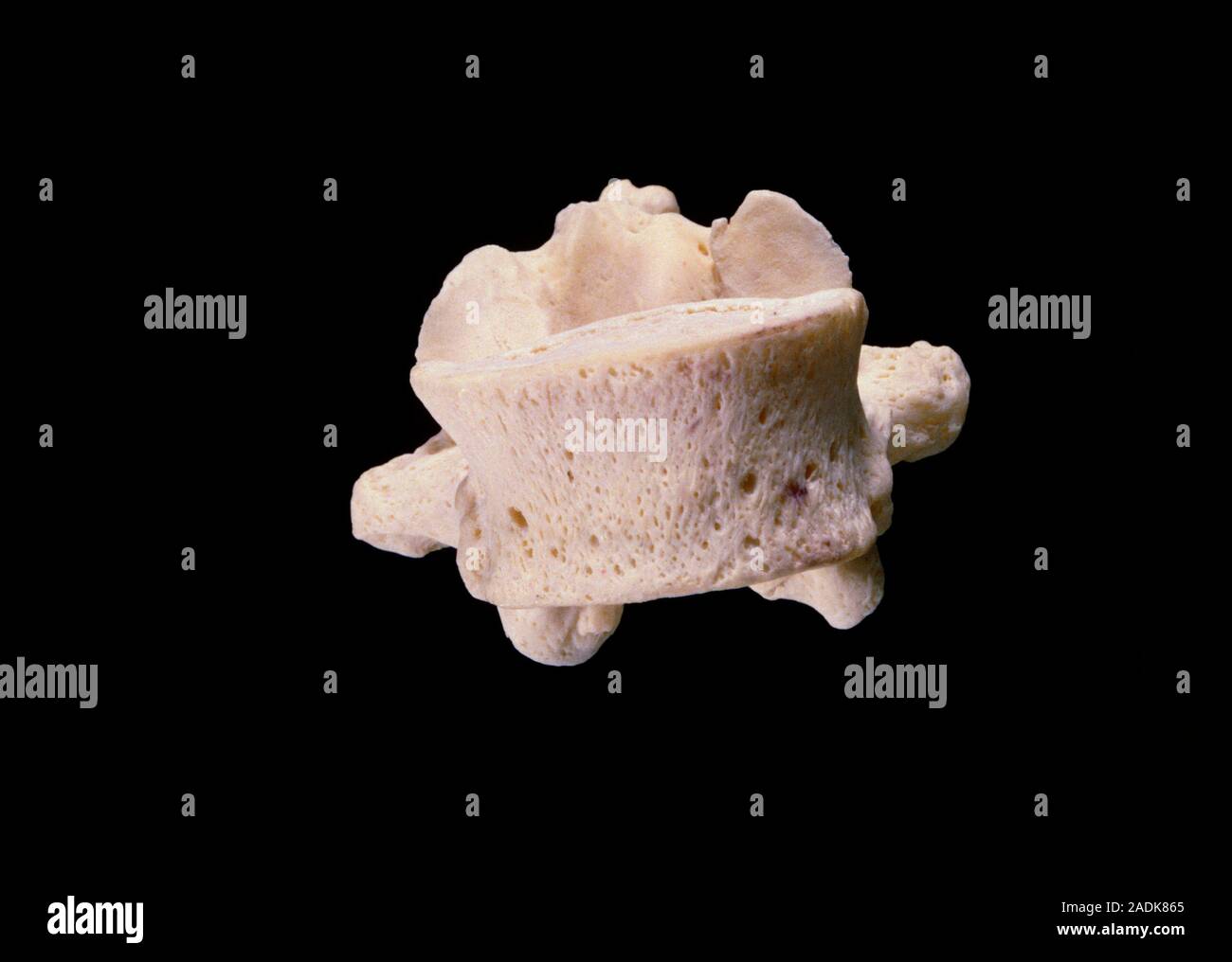 Photograph of the human first lumbar vertebra (L1), one of five bones ...