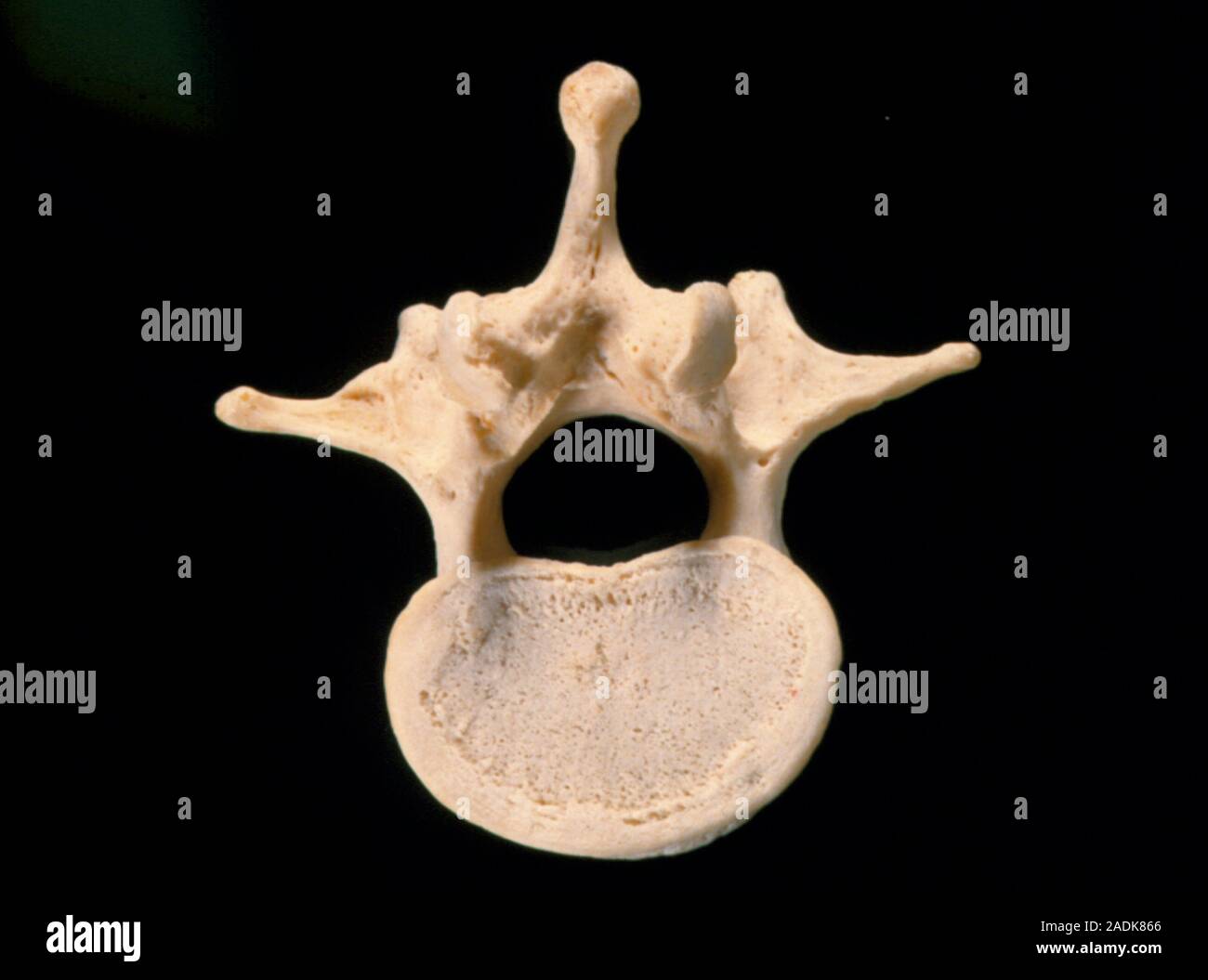 Photograph of the human third lumbar vertebra (L3), one of five bones ...