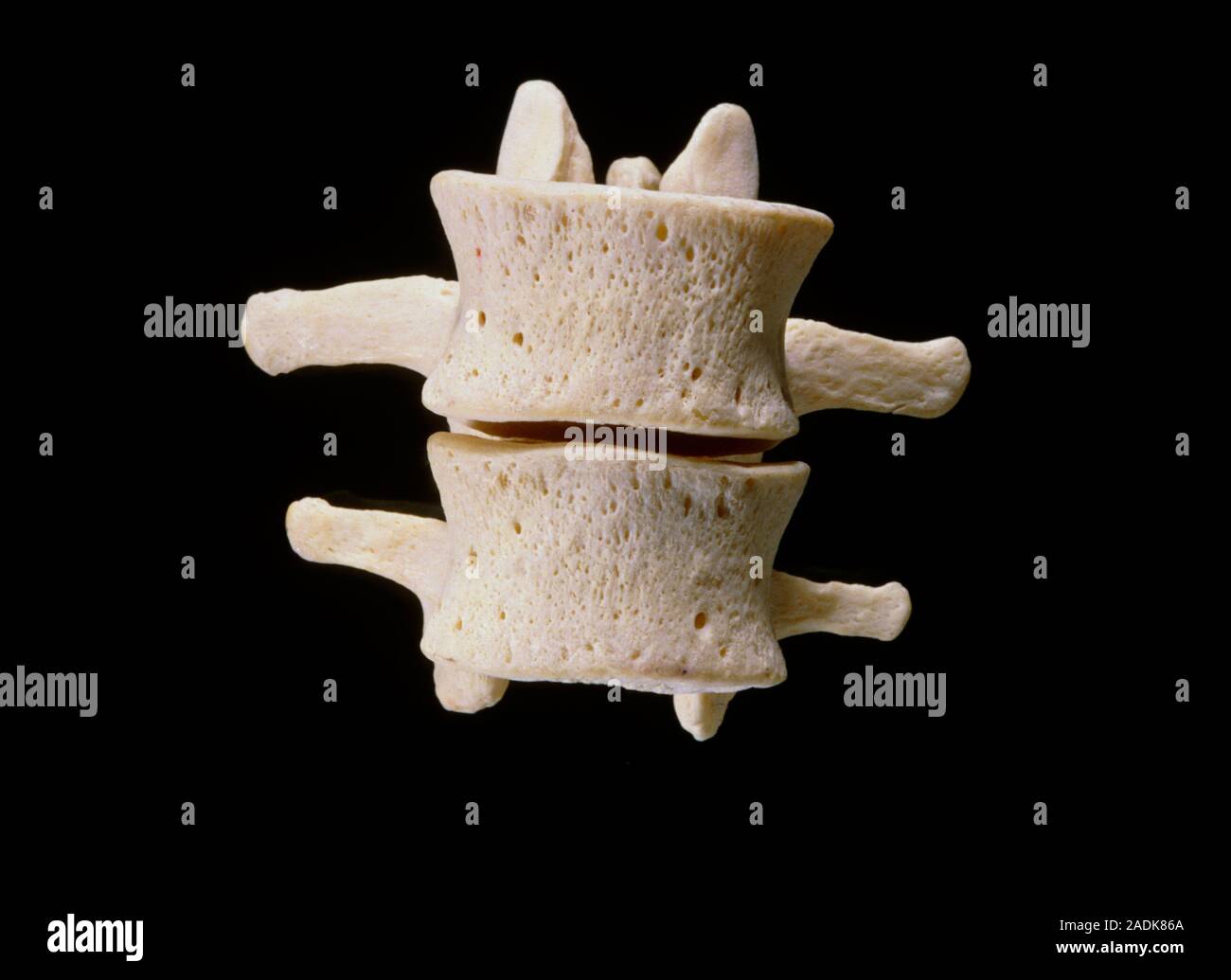 Photograph of the human third and fourth lumbar vertebrae (L3 & L4 ...