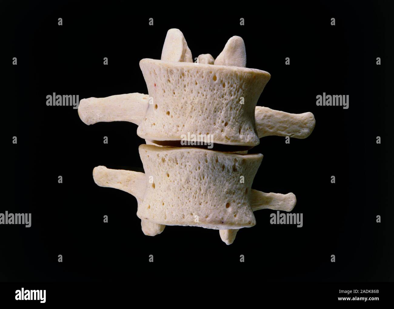 Photograph of the human third and fourth lumbar vertebrae (L3 & L4 ...