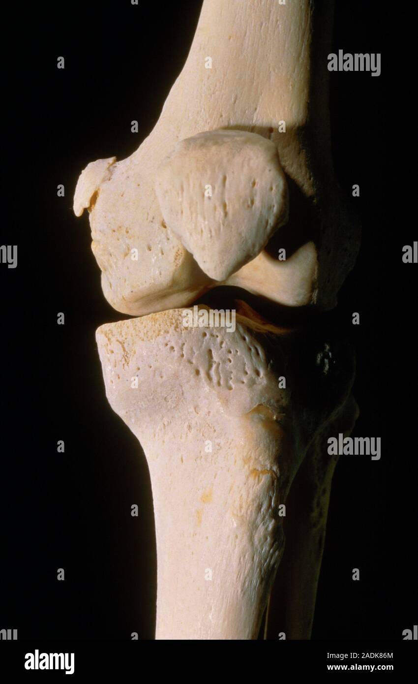 Photograph of the bones articulating in the human left knee (genual ...