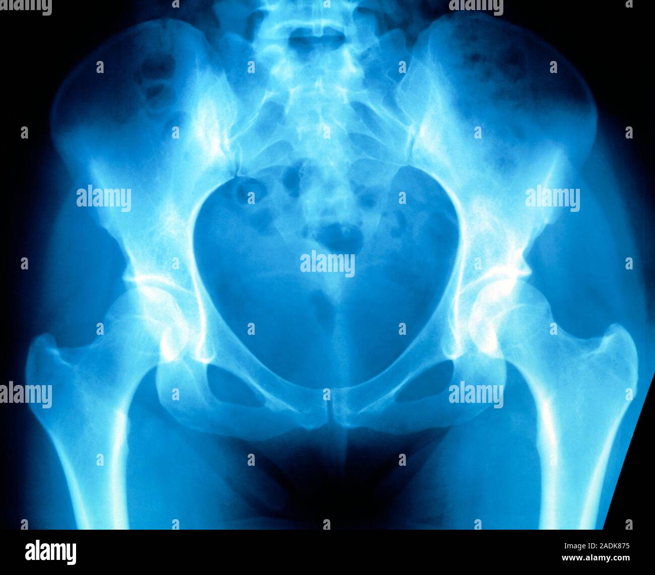 False-colour anteroposterior X-ray of a normal adult, female pelvis ...