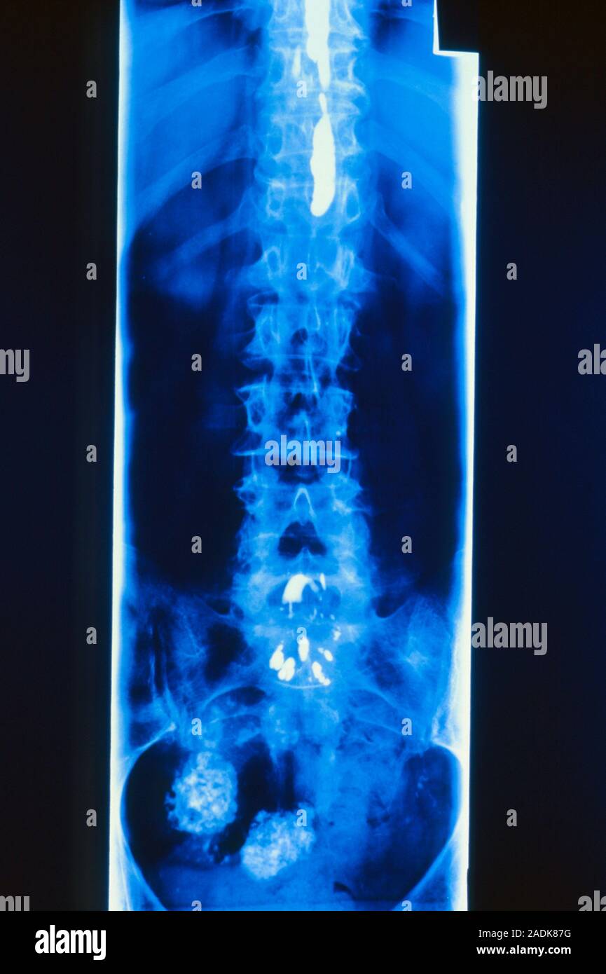 After effects of myelography. Ordinary X-ray image of the human spine ...