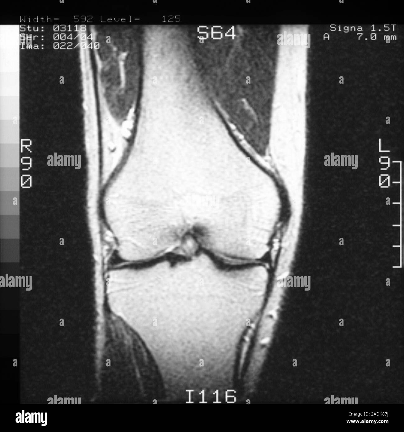 Magnetic resonance image (MRI) of a section through a normal human knee ...