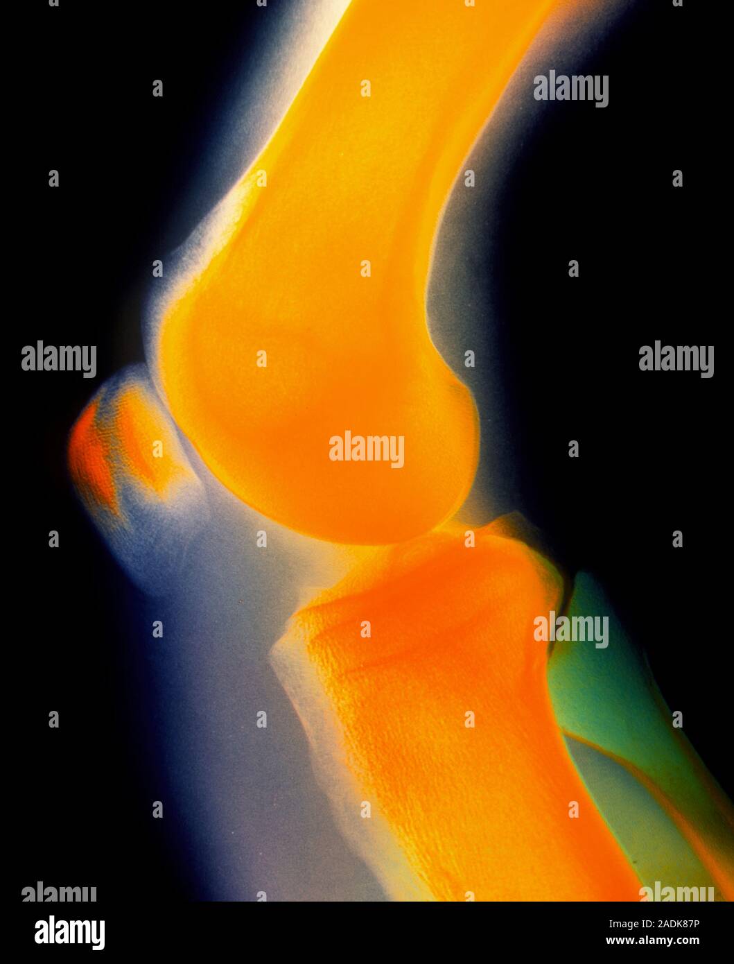 Normal knee. Coloured X-ray of a knee, showing the joint between the ...