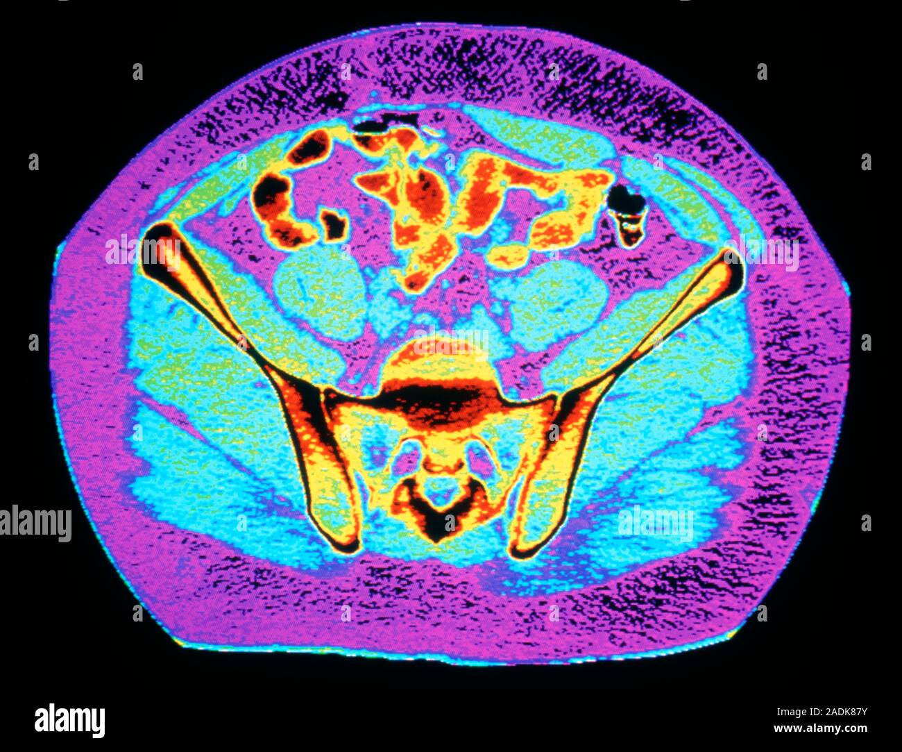 Human pelvis. Coloured computed tomography (CT) scan of bones of a ...
