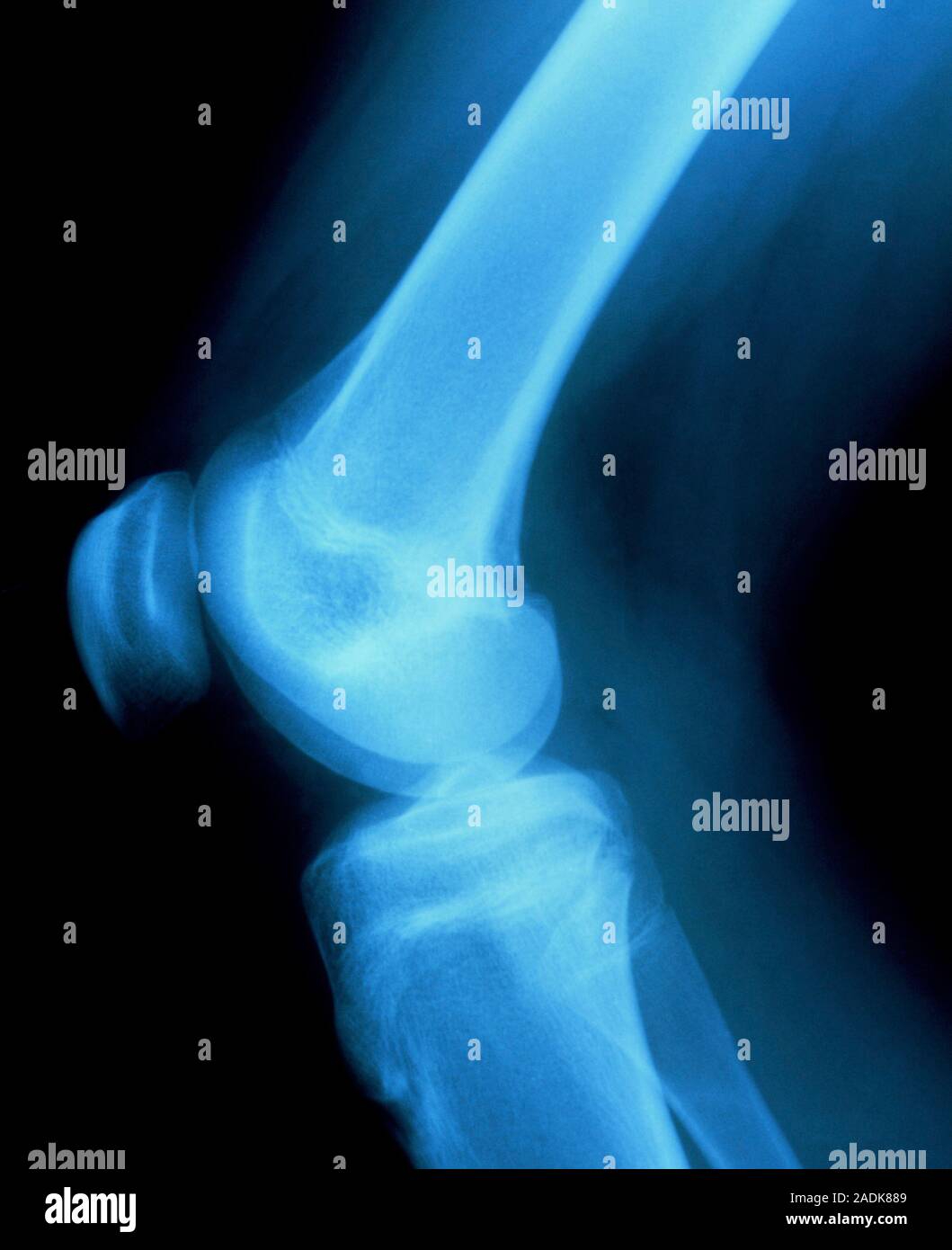 Normal knee. Side-view X-ray of a healthy knee of a 15-year-old girl ...