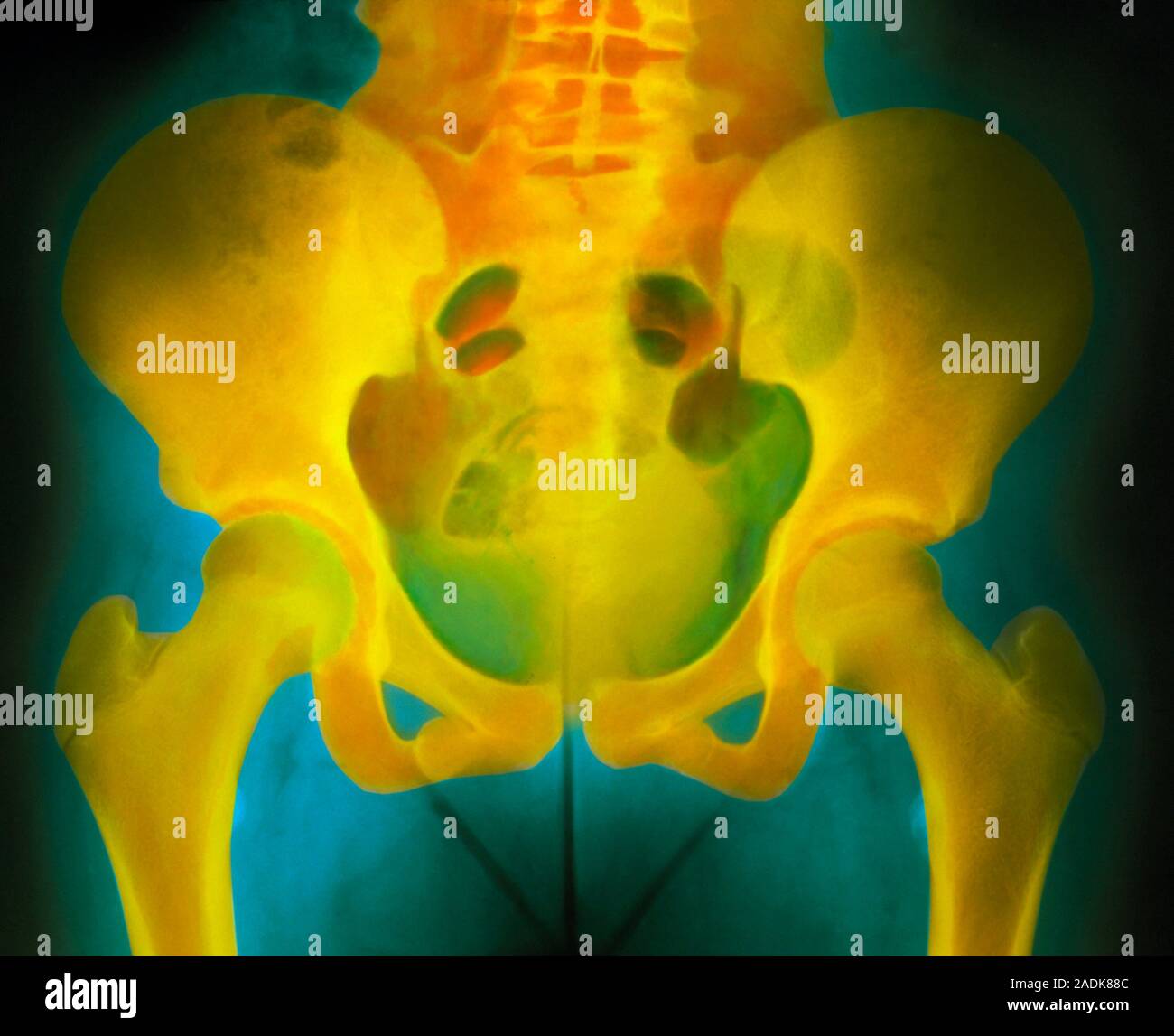 Normal pelvis. Coloured X-ray of the pelvis of a 13-year-old girl. At ...