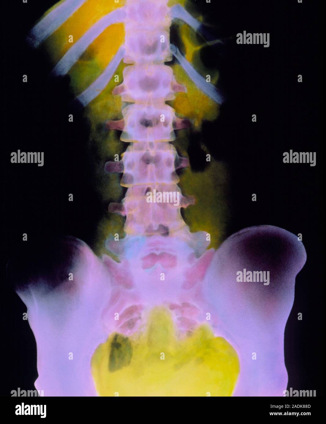 Normal spine and pelvis. X-ray of healthy human lumbar spine (lower ...
