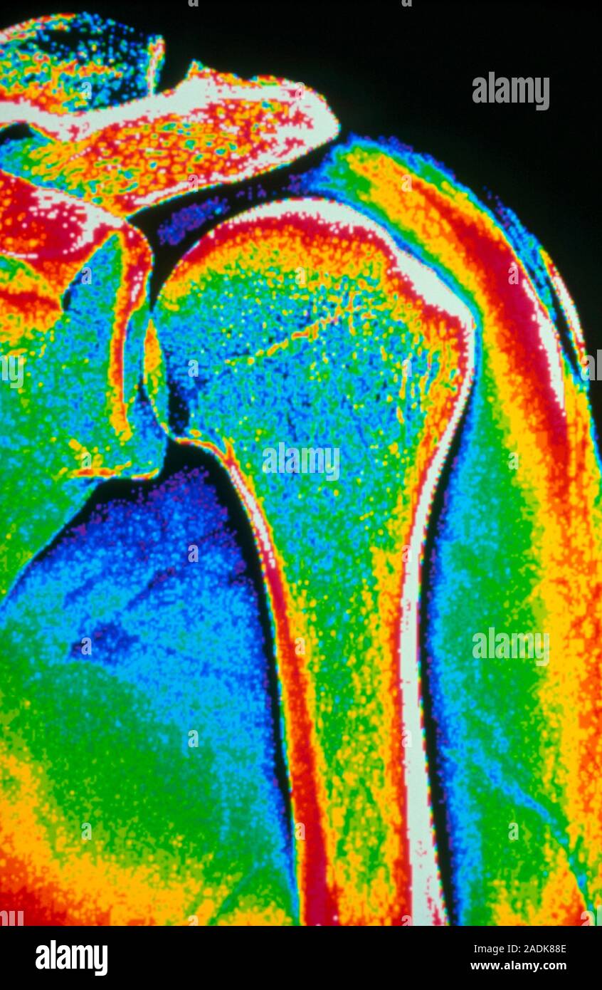 Shoulder. Coloured X-ray of the bones in the human shoulder. Three ...