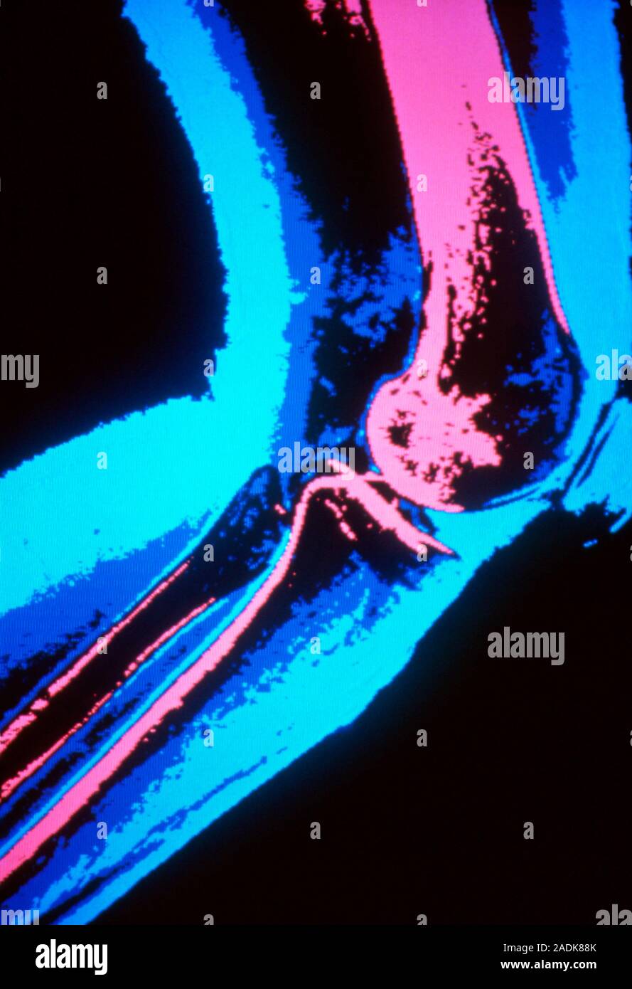Normal knee. Coloured X-ray of the human knee seen from the side while ...