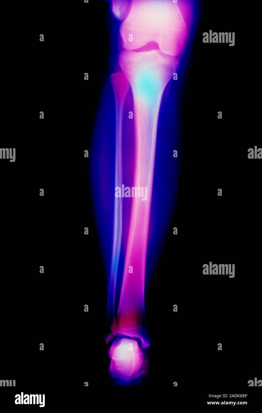 Lower leg. Coloured X-ray of the lower half of a young adult's healthy ...