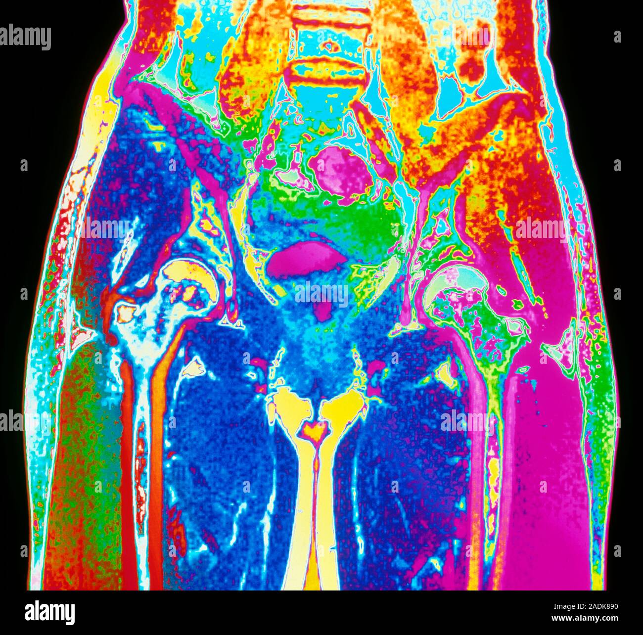 Woman's hips. Coloured Magnetic Resonance Imaging (MRI) scan of a ...