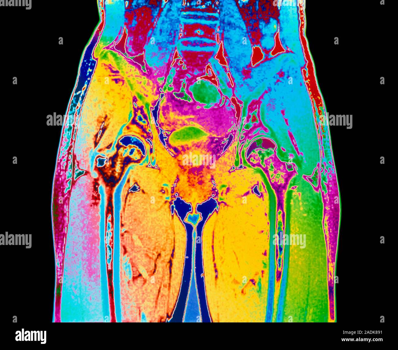 Woman's hips. Coloured Magnetic Resonance Imaging (MRI) scan of a ...