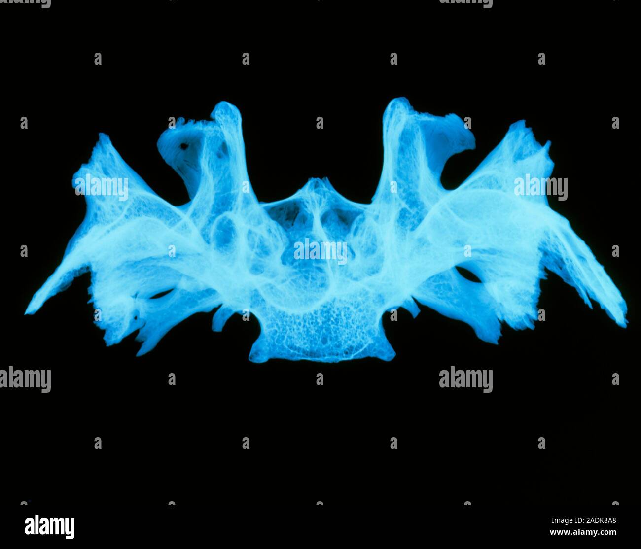 Sphenoid bone. X-ray image of a posterior view of the sphenoid bone ...