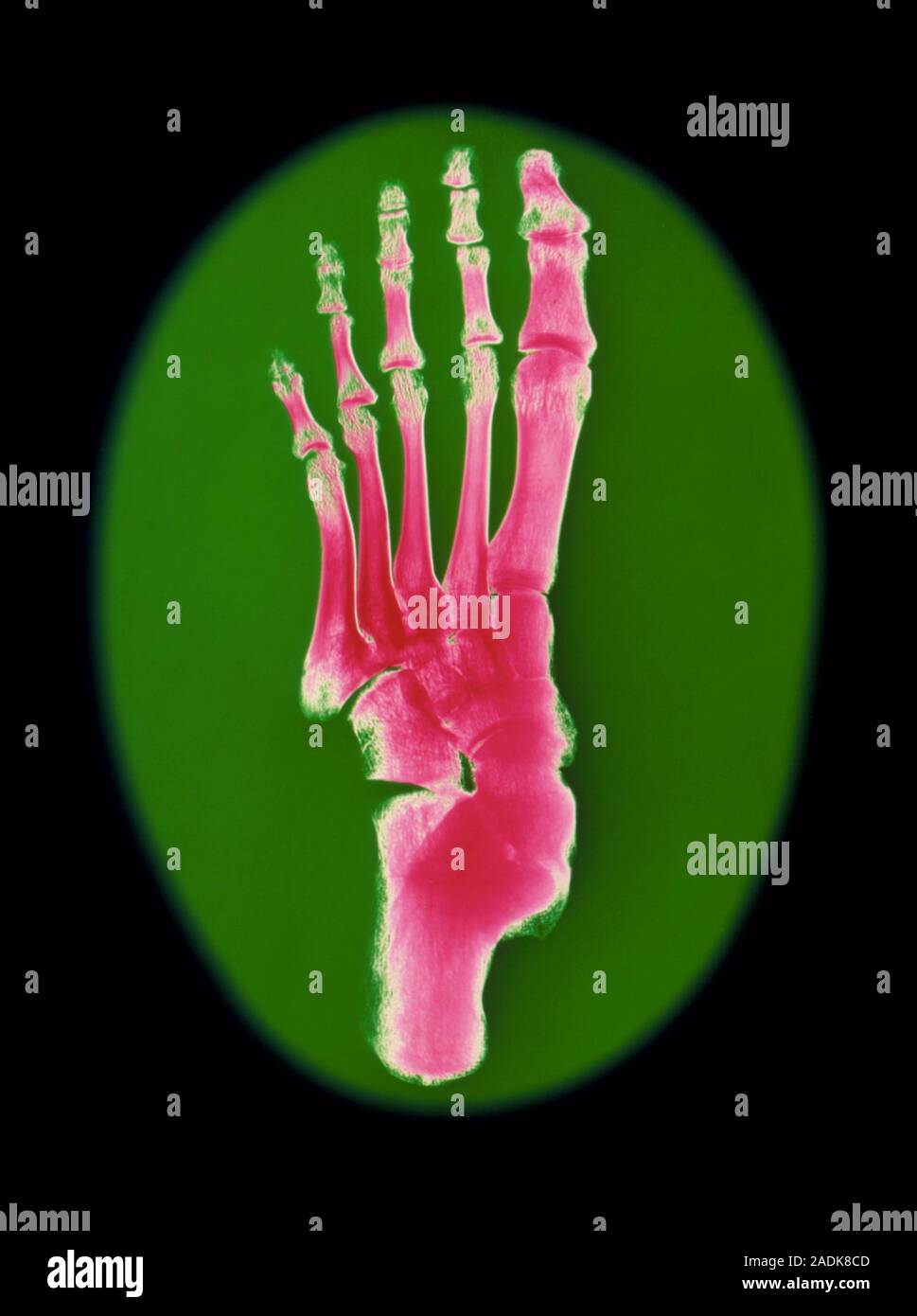 Foot bones. Coloured X-ray of the bones in a healthy human left foot ...
