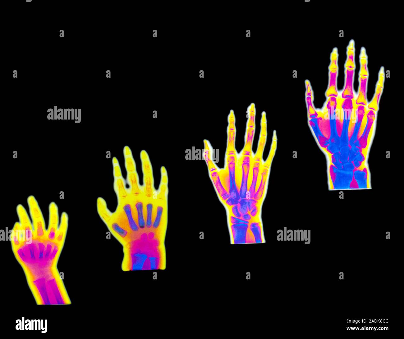 Hand bone growth. X-ray of bone growth of the human hand at different ...