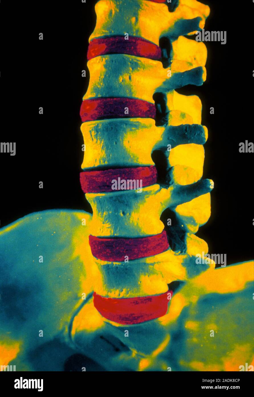 Lower spine. Coloured three-dimensional computed tomography (CT) scan ...