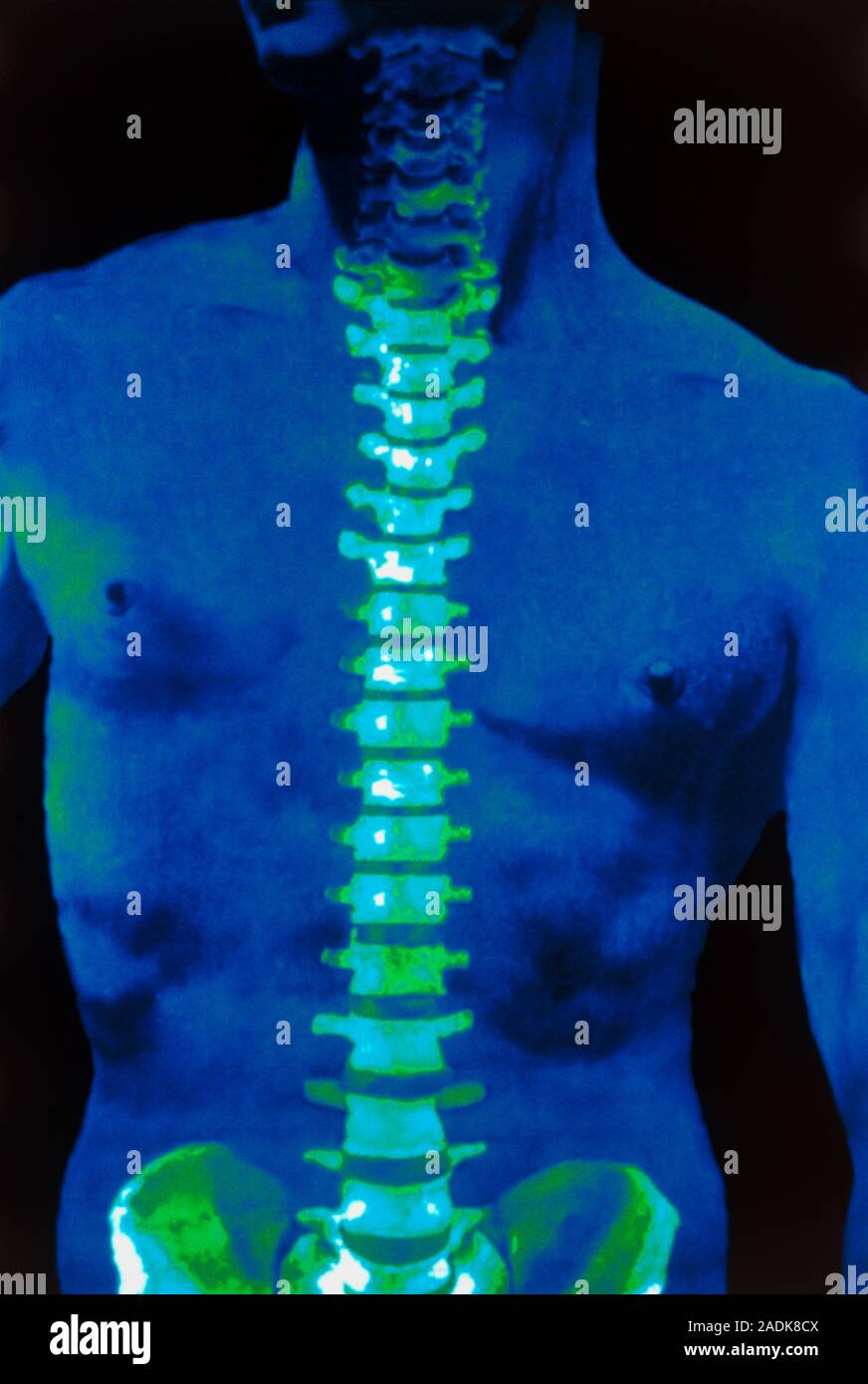 Spine. Coloured three-dimensional computed tomography (CT) scan of a ...
