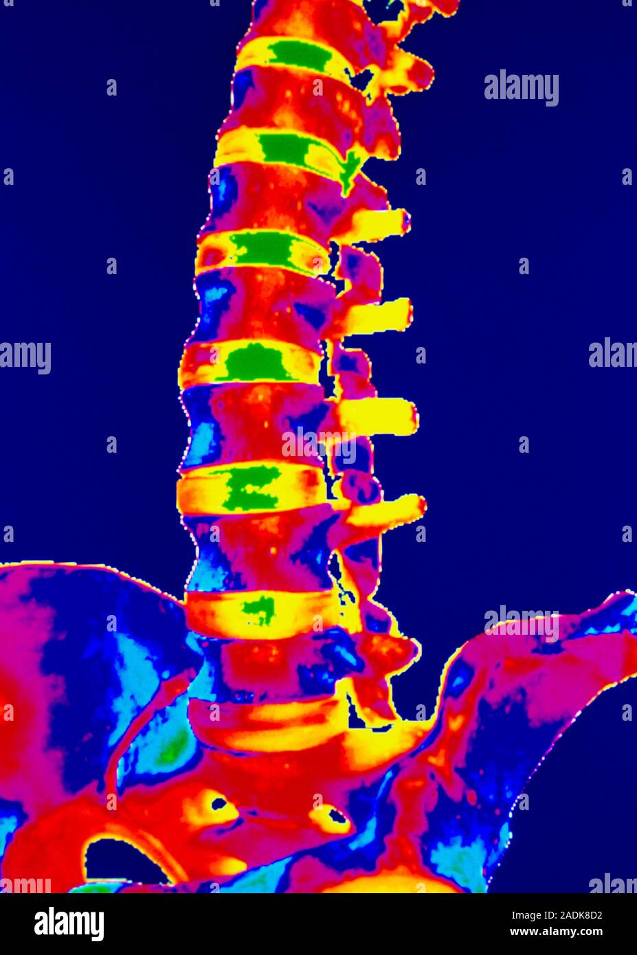 Lower spine. Coloured three-dimensional computed tomography (CT) scan ...