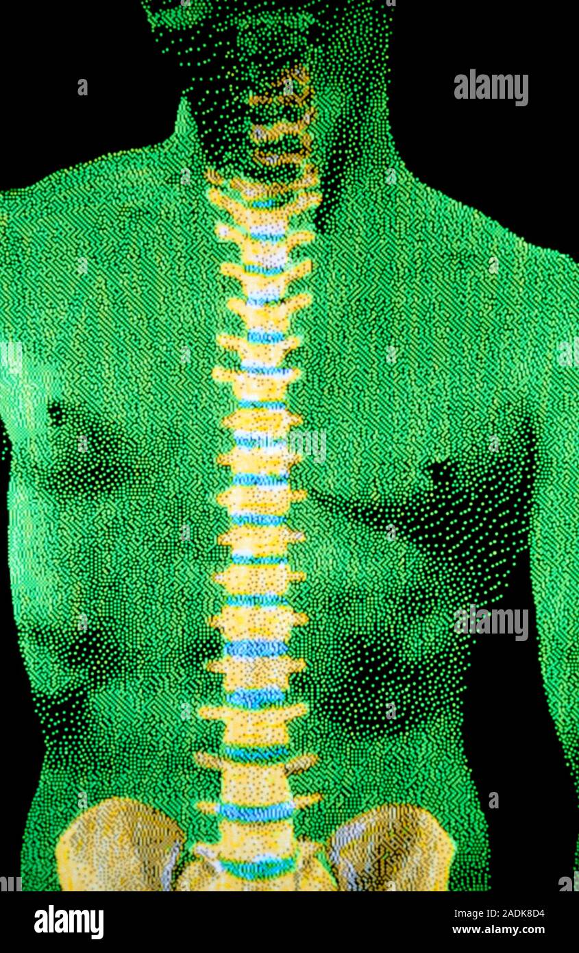 Spine. Coloured three-dimensional computed tomography (CT) scan of a ...