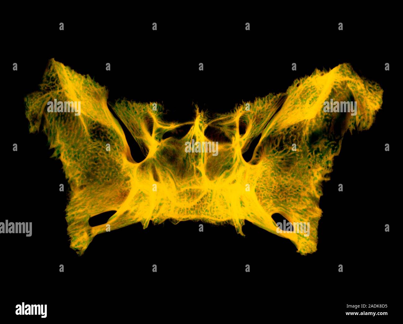 Sphenoid bone. Coloured X-ray of a superior aspect of the sphenoid bone ...