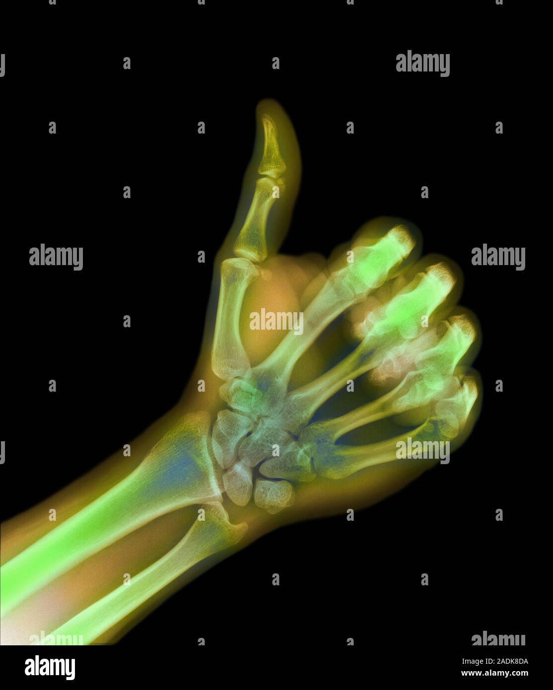 Hand with thumb up. Coloured X-ray of a hand with its thumb up. Apart ...