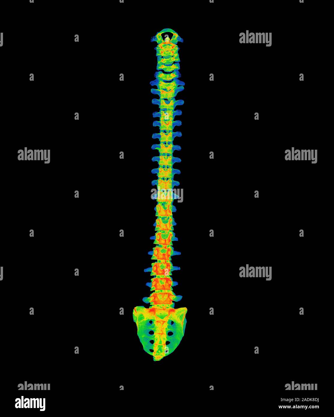 Spine. Coloured X-ray showing a healthy human spine seen from the front ...