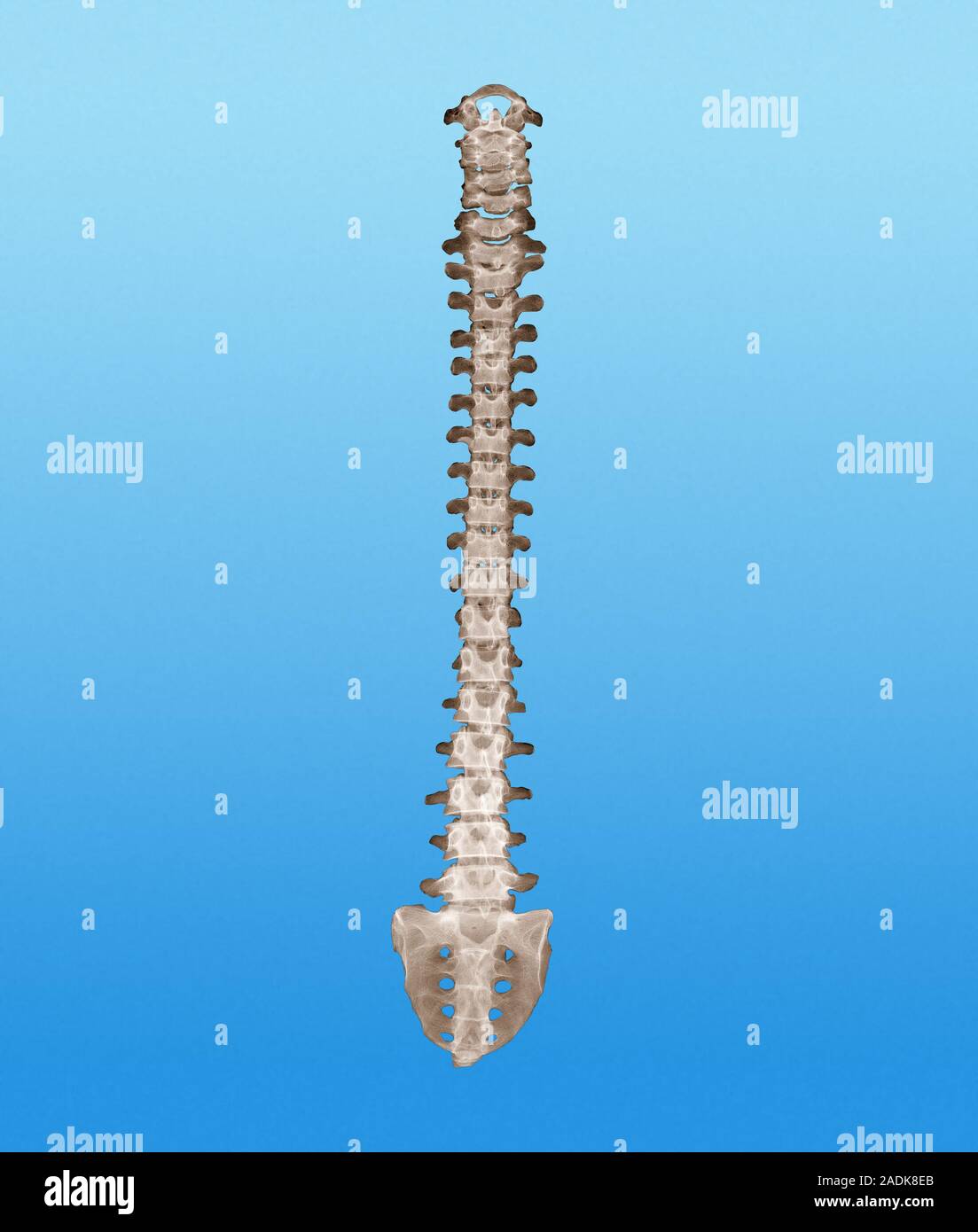 Spine. Coloured X-ray showing a healthy human spine seen from the front ...