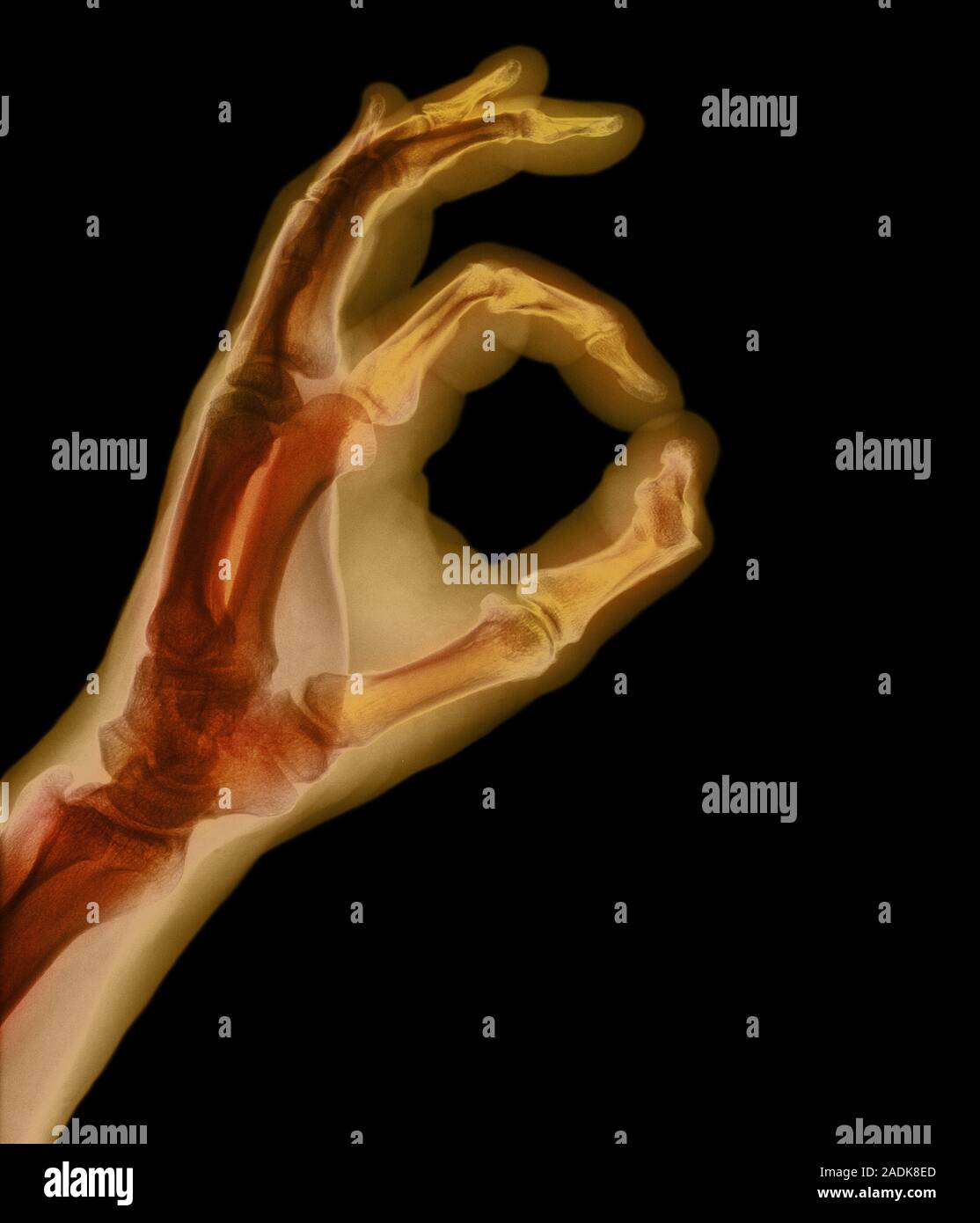 Fingers forming O. Coloured X-ray of a hand in side view, with the ...