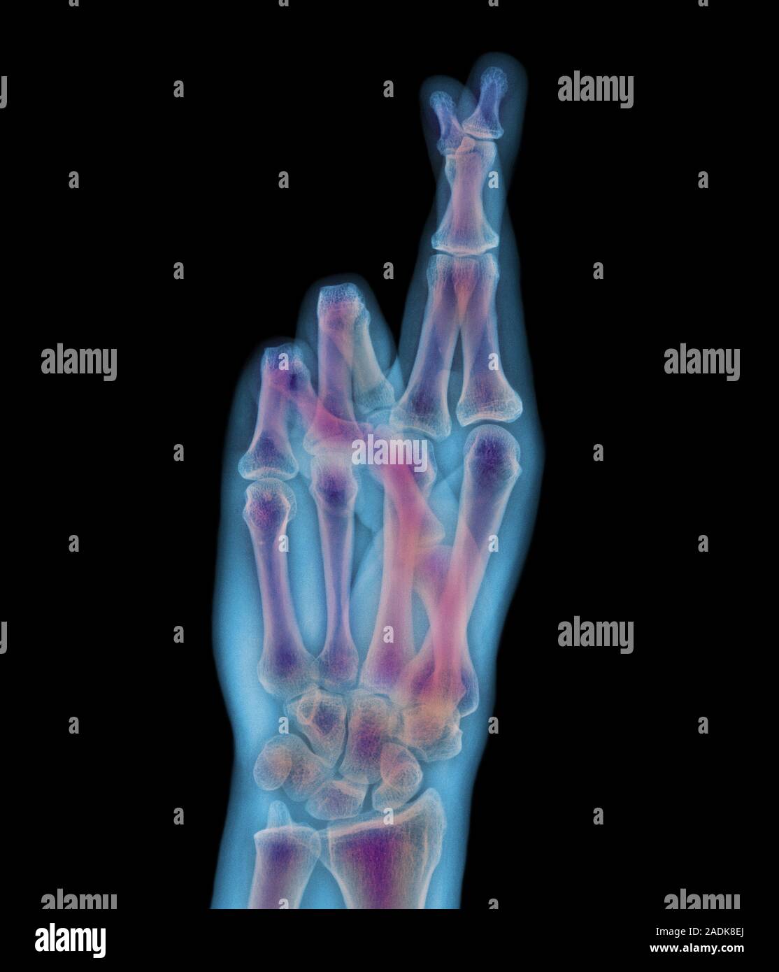 Fingers crossed. Coloured X-ray of a hand in top view, with the ...
