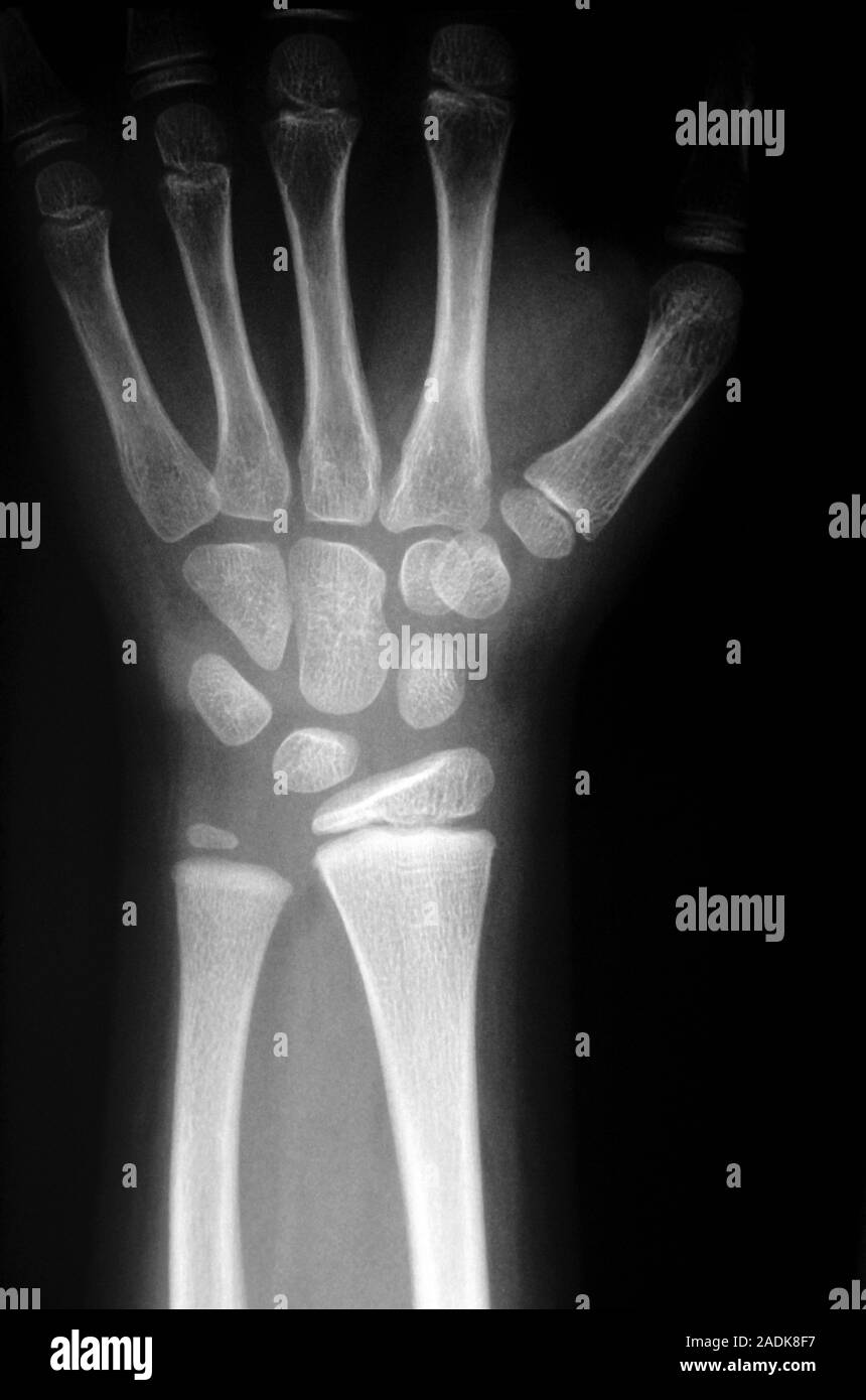 Wrist bones. X-ray of the bones in a healthy wrist. At centre are the ...