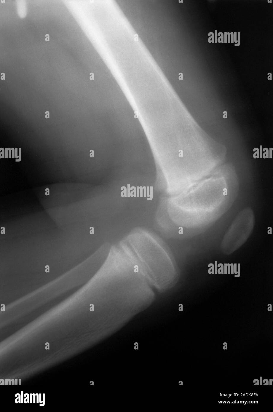 Healthy knee. Side-view X-ray of a healthy knee of a 7-year-old girl ...