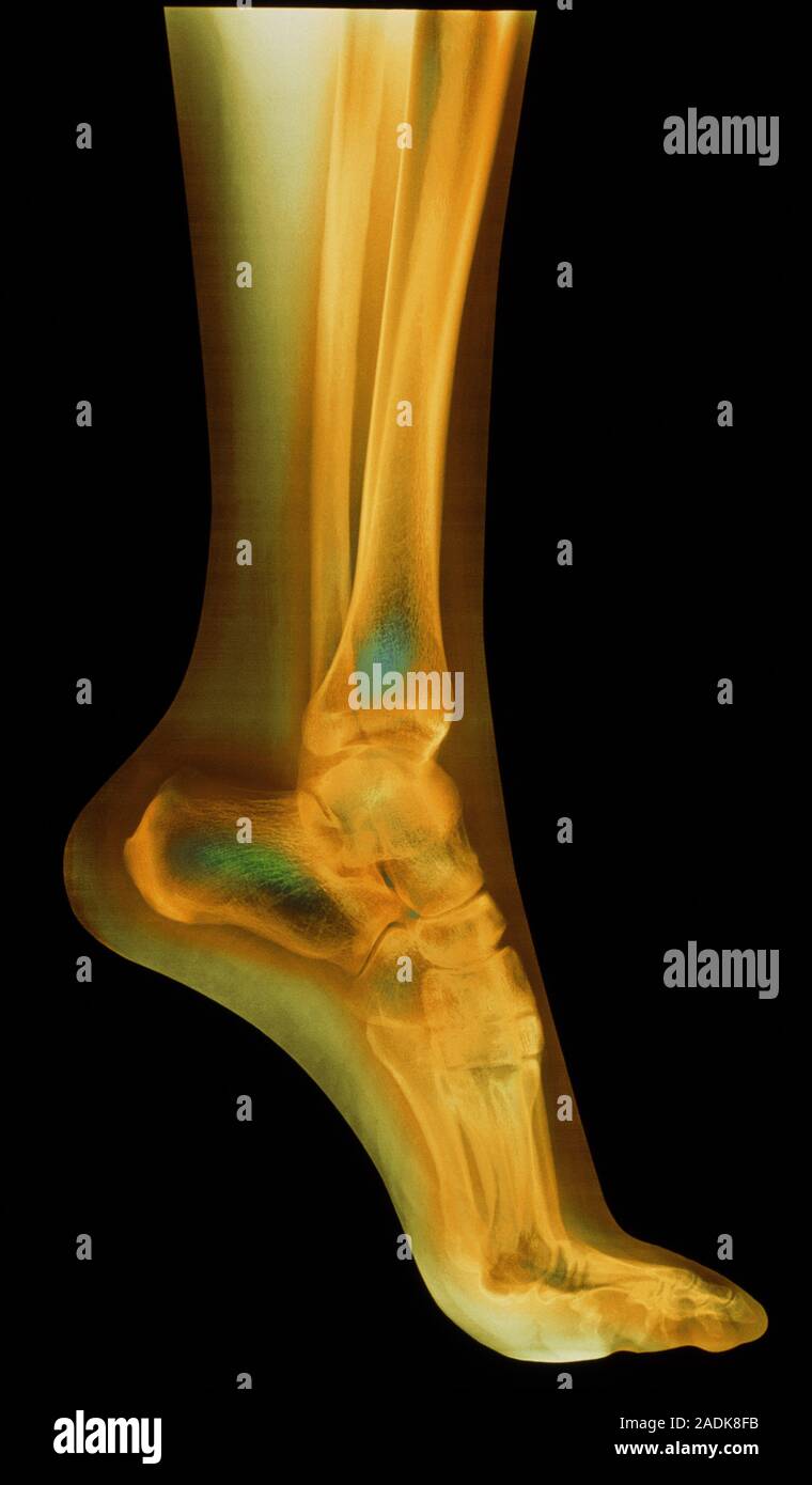 Lateral Foot Anatomy Soft Tissue