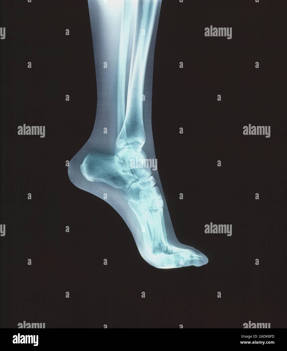 Healthy foot. Coloured X-ray of a foot on tiptoe seen from the side ...