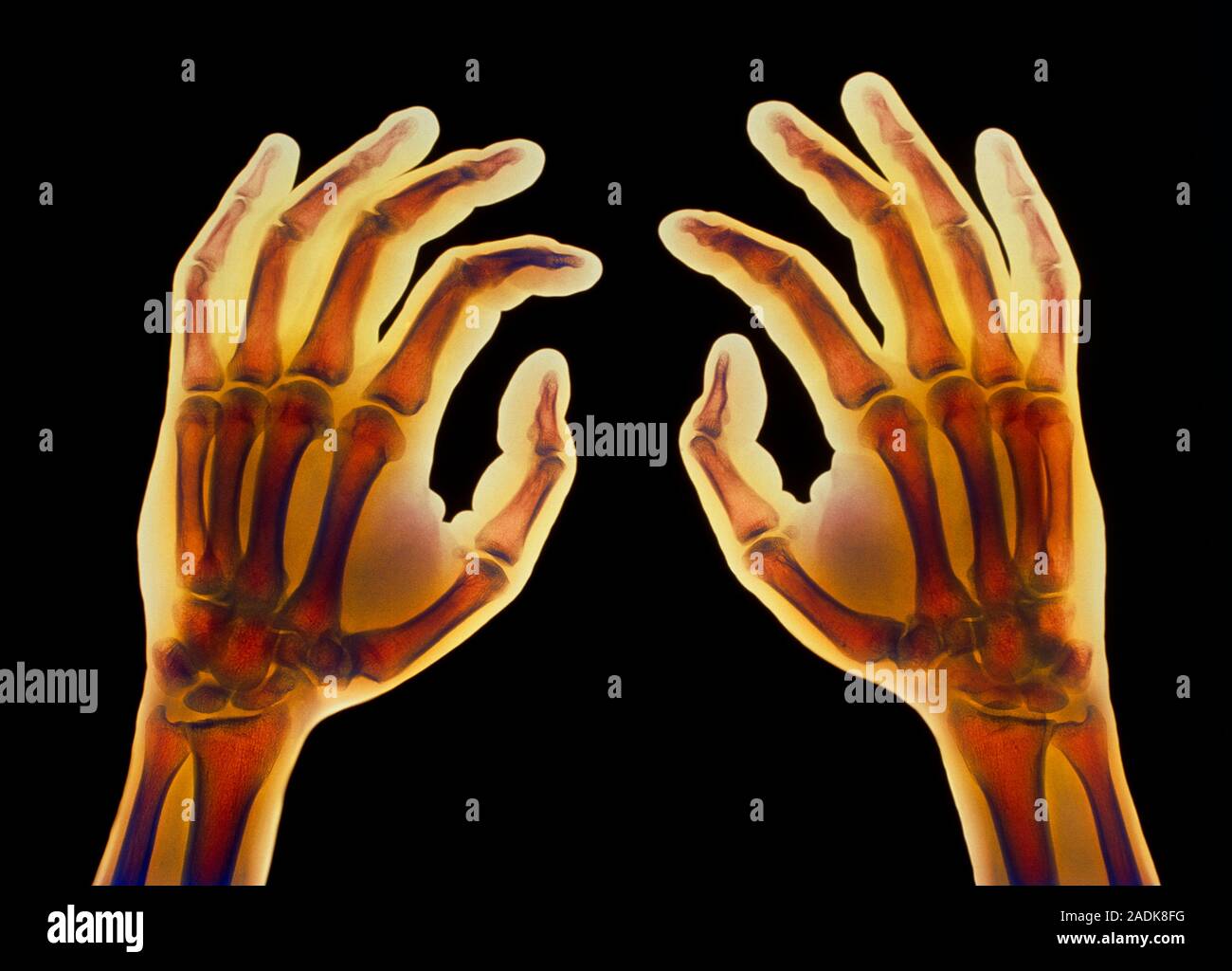 Healthy hands. Coloured X-ray of healthy human hands. Bone is orange ...