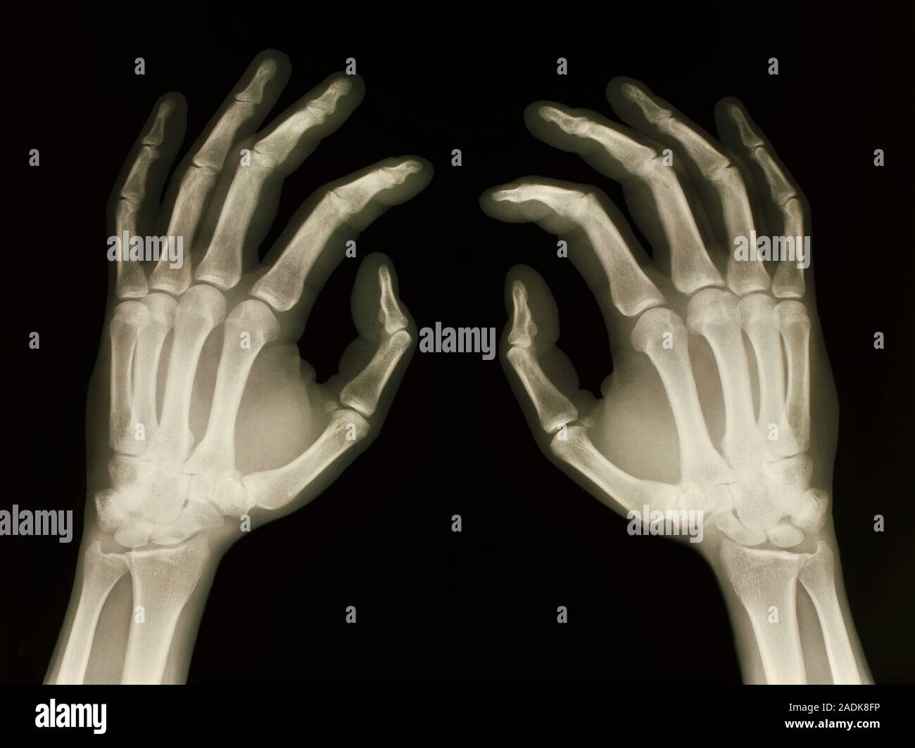 Healthy hands. X-ray of healthy human hands. The bones are white and ...