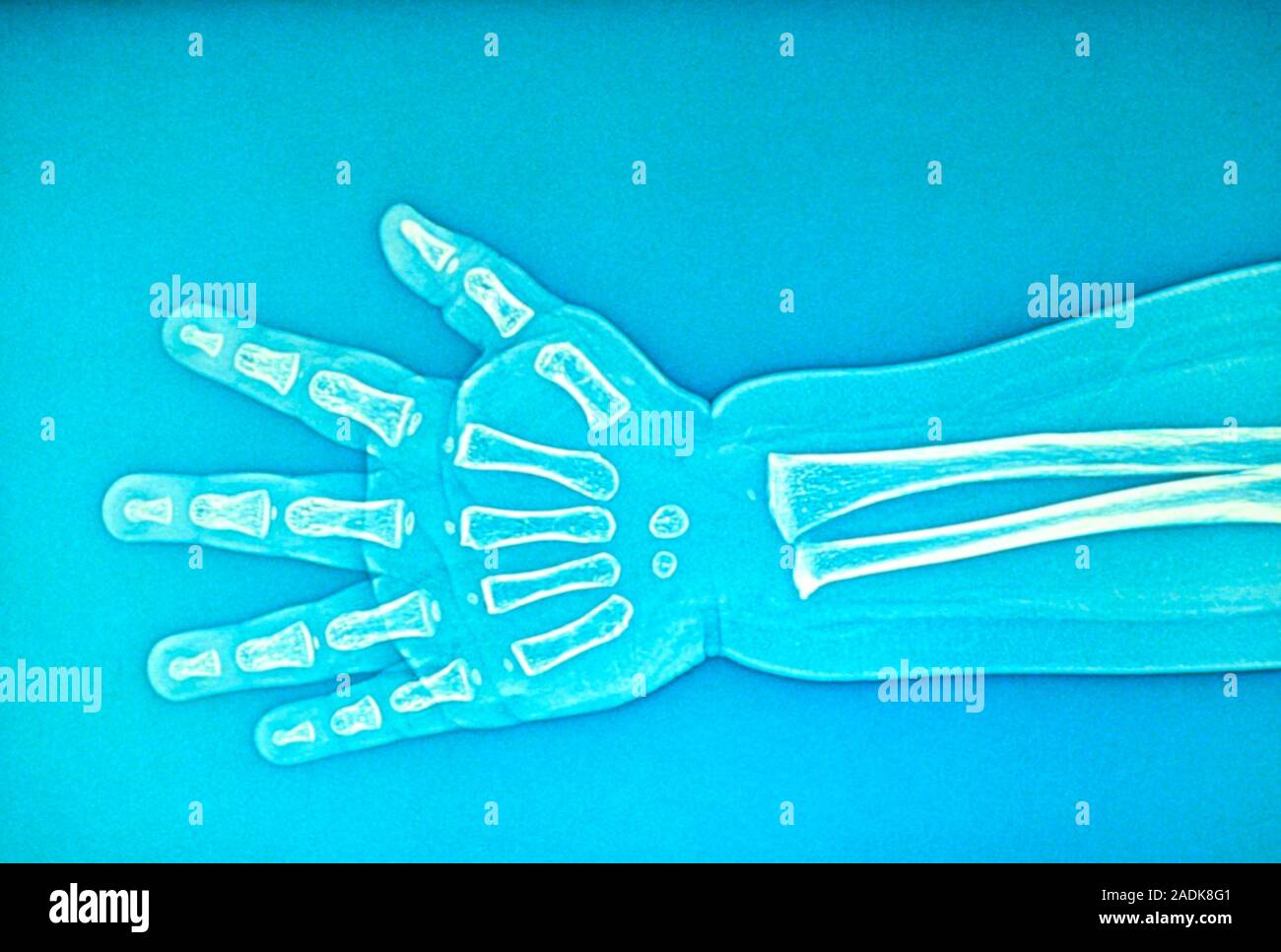 Child's hand bones (1 year old). Coloured X-ray showing the bones in ...