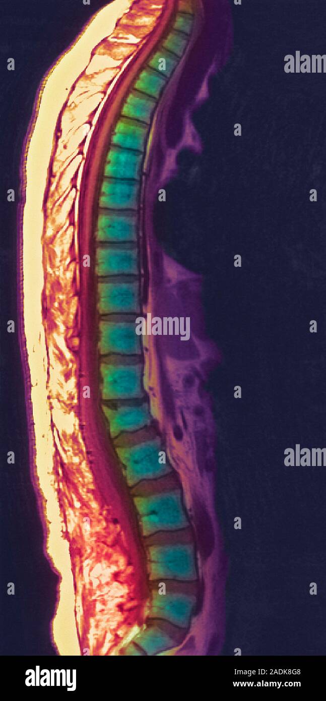 Backbone. Coloured magnetic resonance imaging (MRI) scan of a healthy ...