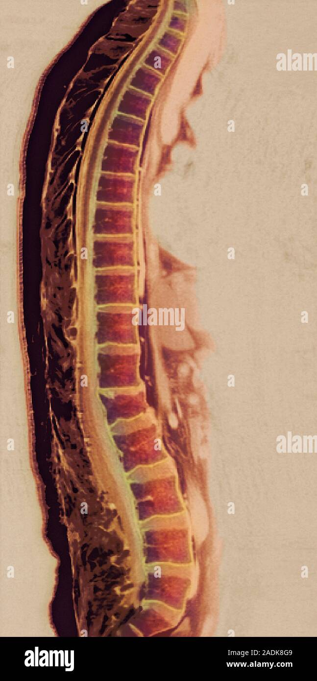Backbone. Coloured magnetic resonance imaging (MRI) scan of a healthy ...