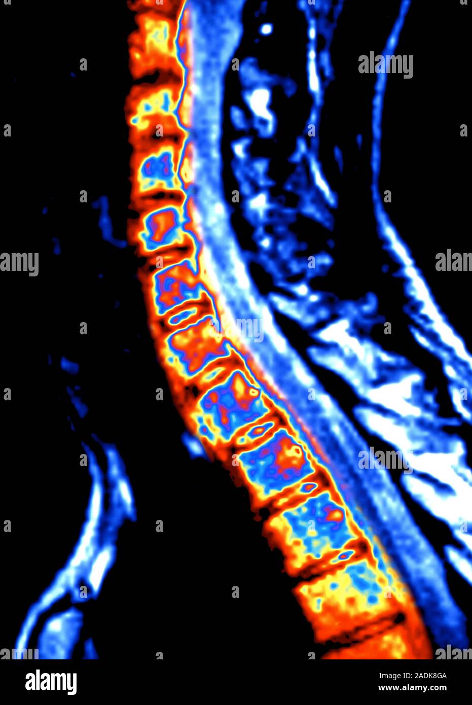 Cervical spine. Coloured computed tomography (CT) scan of the side of ...