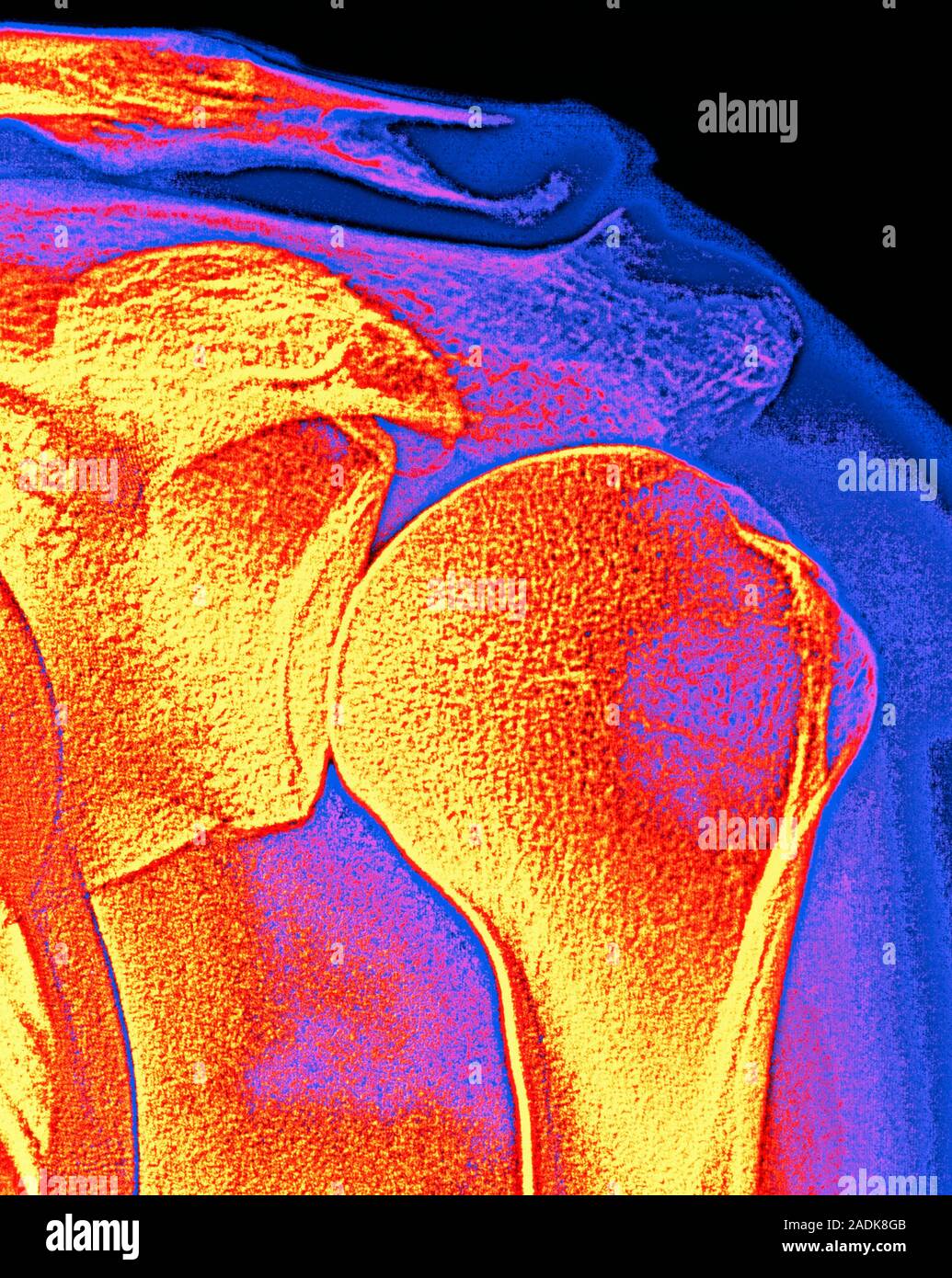 Shoulder. Coloured X-ray of a healthy shoulder joint. The joint is a ...