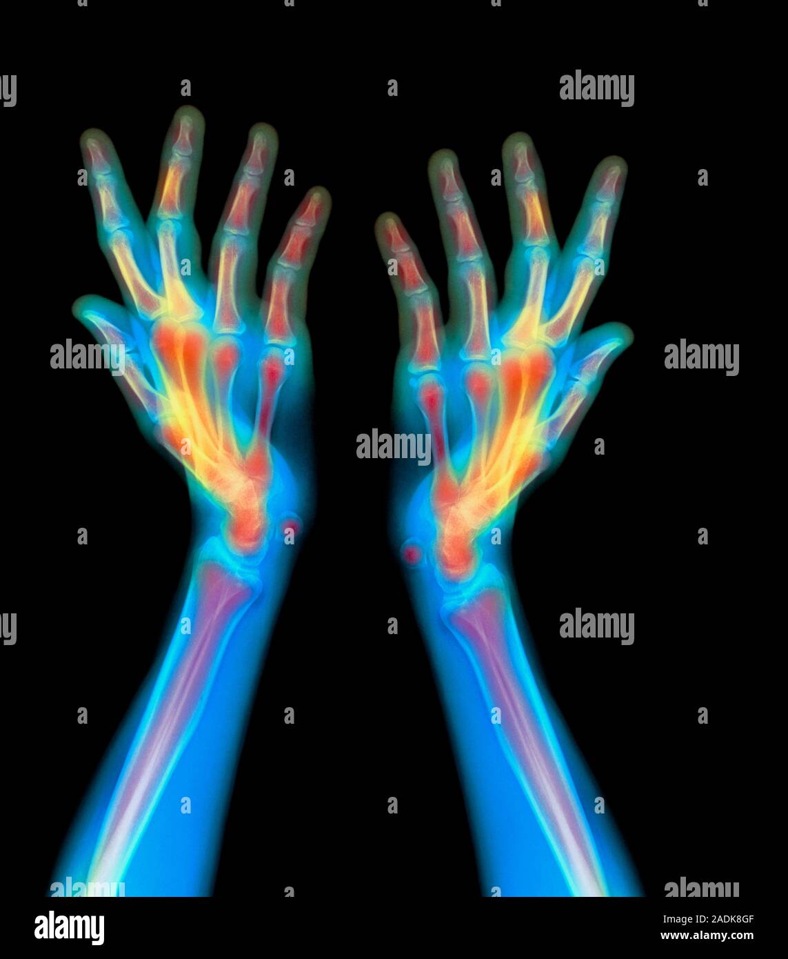 Hands, coloured X-ray. Flesh is blue and bones are yellow, orange and ...
