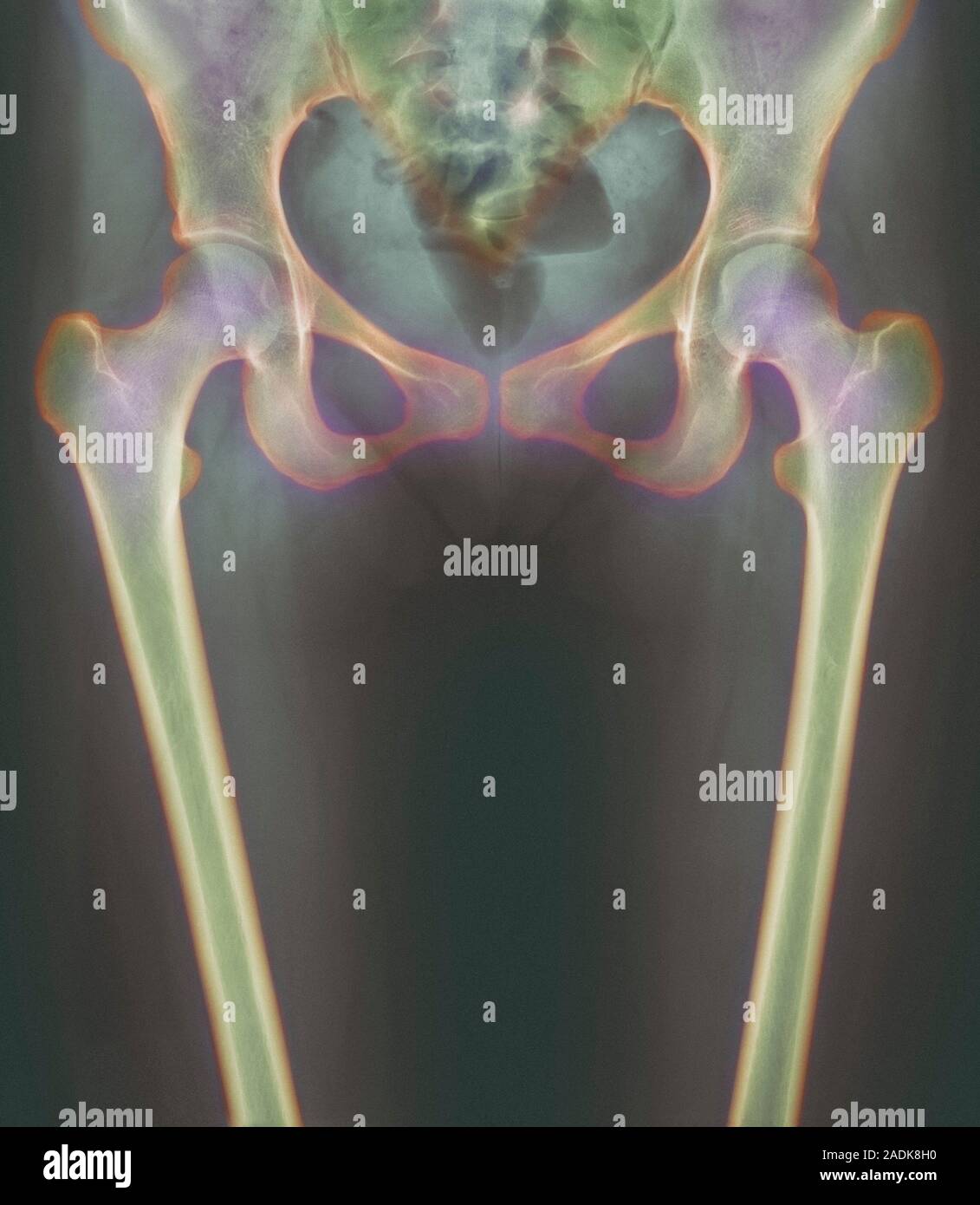 Hip joints. Coloured X-ray of a woman's groin and upper legs, revealing ...